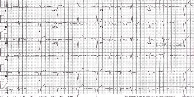 Atrial Fib, Bifascicular Block, Pacemaker | ECG Guru - Instructor Resources