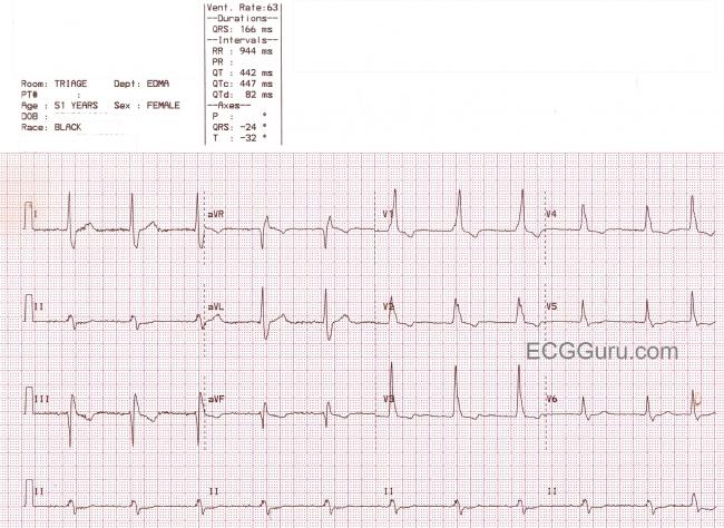 Right Bundle Branch Block With Atypical QRS in V1 and LAFB or ...