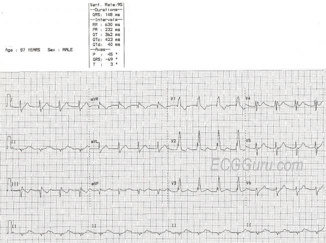 First-degree AV block | ECG Guru - Instructor Resources