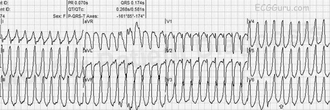 Ventricular Tachycardia In A Patient With Myopathy Ecg Guru