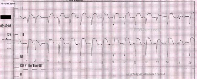 Accelerated idioventricular rhythm | ECG Guru - Instructor Resources