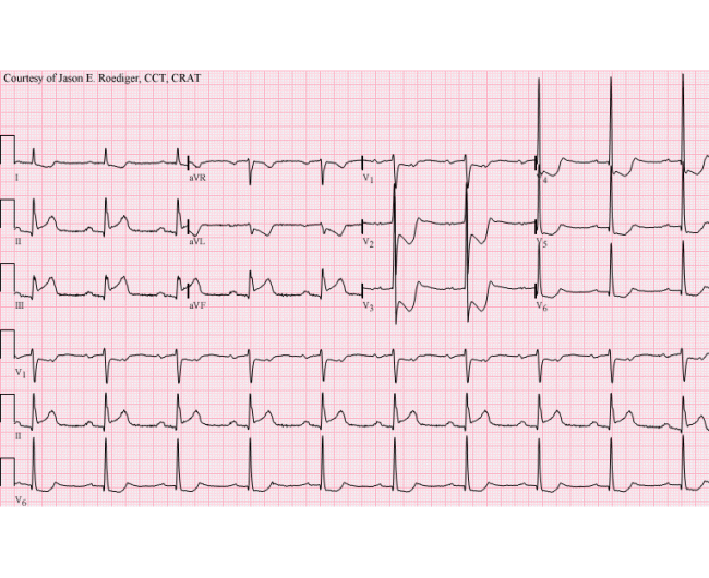 Inferoposterior M.I. | ECG Guru - Instructor Resources