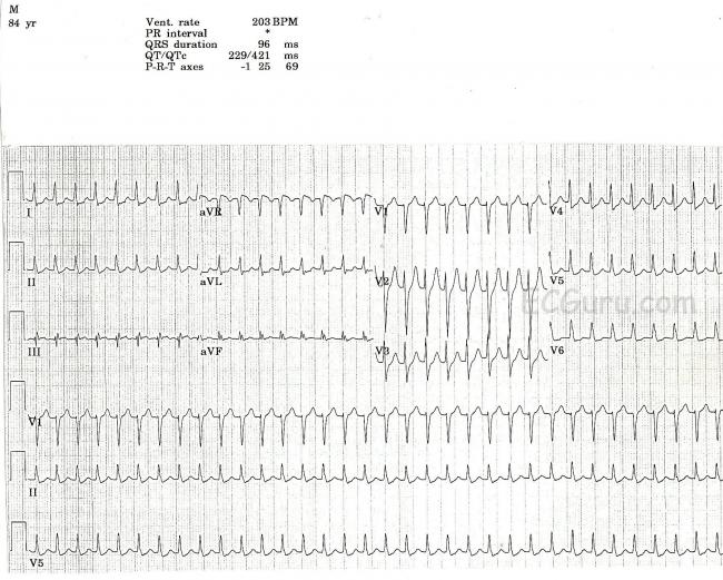 Paroxysmal Supraventricular Tachycardia Ecg Guru | Images and Photos finder Paroxysmal Supraventricular Tachycardia Ecg Guru | Images and Photos finder