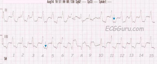 Capture beats | ECG Guru - Instructor Resources