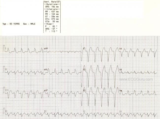 Wide Complex Tachycardia: Left Bundle Branch Block | ECG Guru ...