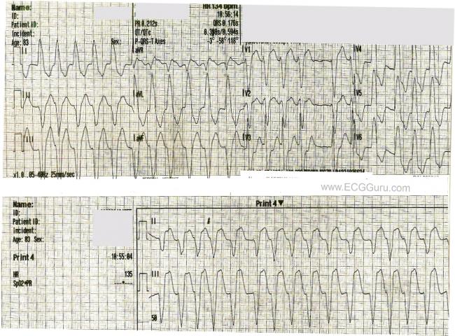 Wide Complex Tachycardia, 12 Lead ECG and Rhythm Strip | ECG Guru ... Wide Complex Tachycardia, 12 Lead ECG and Rhythm Strip | ECG Guru ...