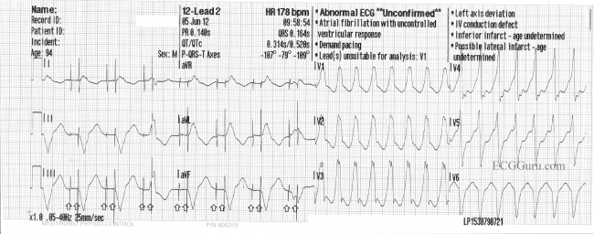 Pacemaker Ecg Guru Instructor Resources