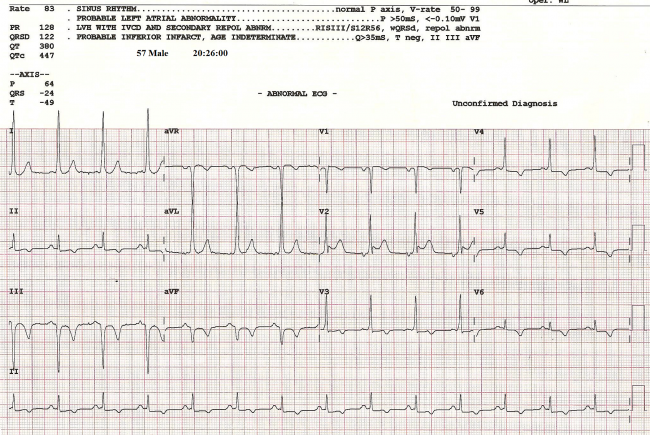 Wolff-Parkinson-White | ECG Guru - Instructor Resources