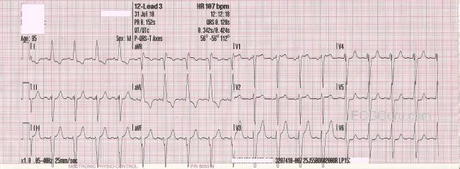 Wide QRS | ECG Guru - Instructor Resources